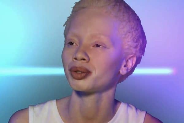 Famous Albino People You Should Know